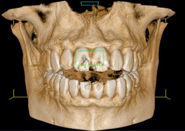 Tac cbct